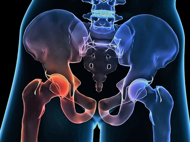 Dolori articolari: anca destra e potenzialità femminile - Alessia Macci ...